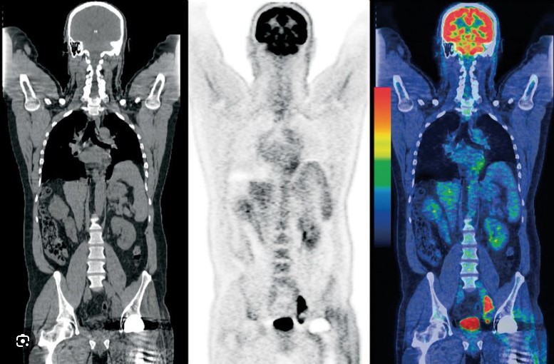 PET CT con 18F-FDG - Hospital Universitario San Cecilio